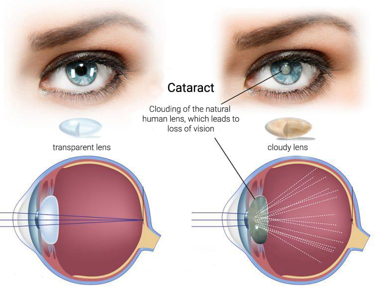 Ayurvedic Panchakarma Treatment For Cataract Ayurvedic Panchakarma Treatment For Cataract