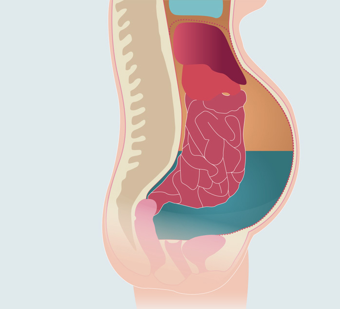 Home Remedies for Ascites