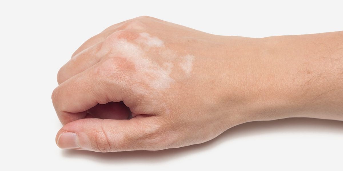 What should you eat and avoid in leucoderma?