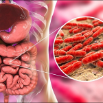 Treatment for Ulcerative Colitis