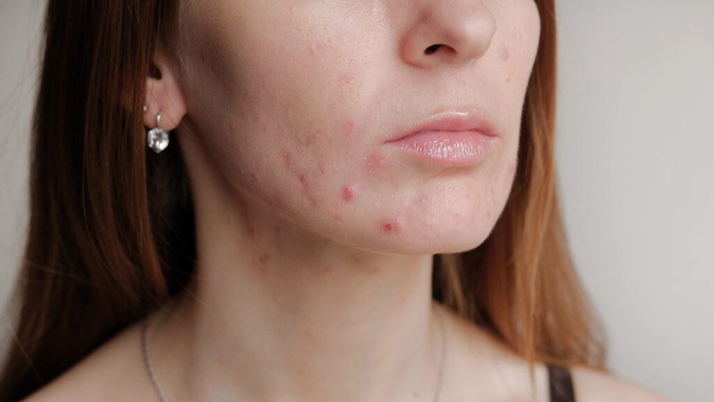 BLEMISHES | Chandigarh Ayurved & Panchakarma Centre