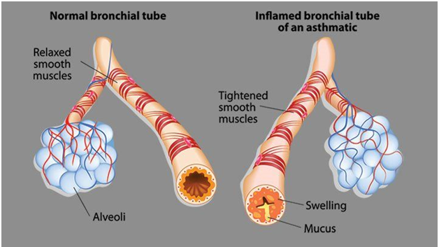 Permanent Cure For Asthma In Ayurveda Chandigarh Ayurved