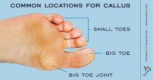 CORNS AND CALLUSES