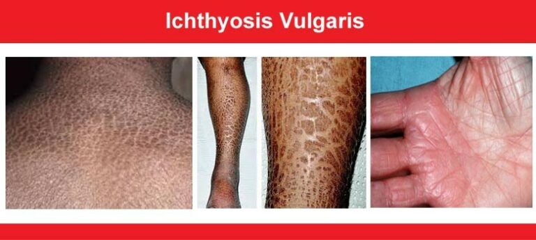 Ichthyosis Vulgaris | Chandigarh Ayurved and Panchkarma Centre