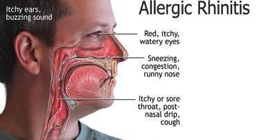 Home Remedies for Rhinitis | CAC