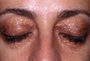 What is Syringoma? | Chandigarh Ayurved & Panchakarma Centre