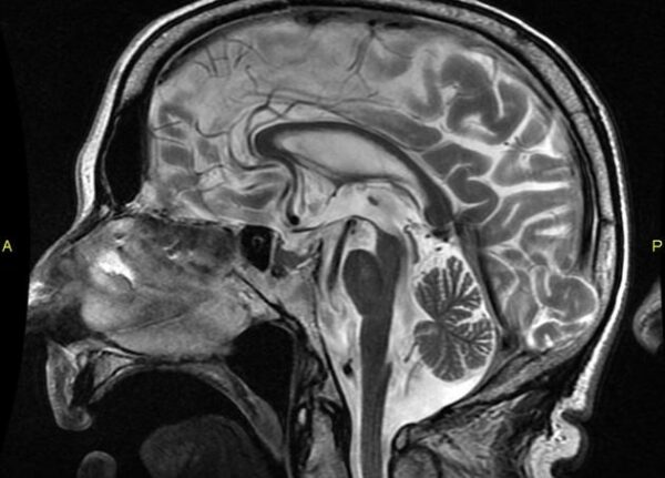 PROGRESSIVE SUPRANUCLEAR PALSY | Chandigarh Ayurved & Panchakarma Centre