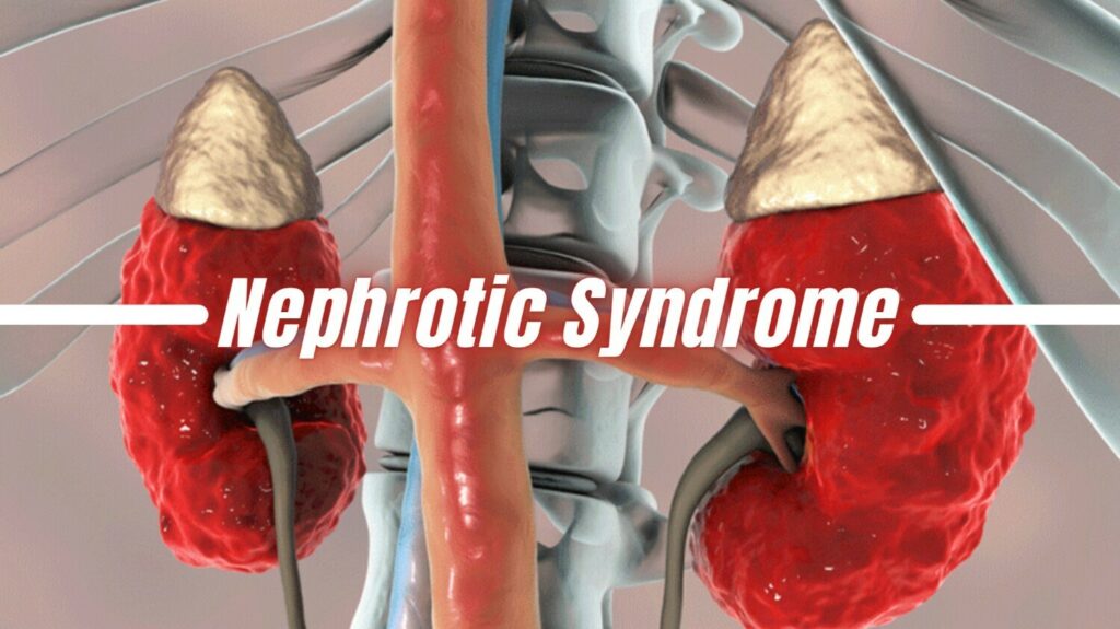 NEPHROTIC SYNDROME AND ITS AYURVEDIC TREATMENT | Chandigarh Ayurved ...