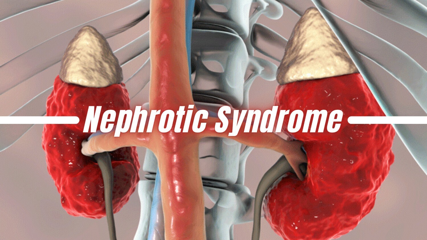 NEPHROTIC SYNDROME AND ITS AYURVEDIC TREATMENT | Chandigarh Ayurved ...