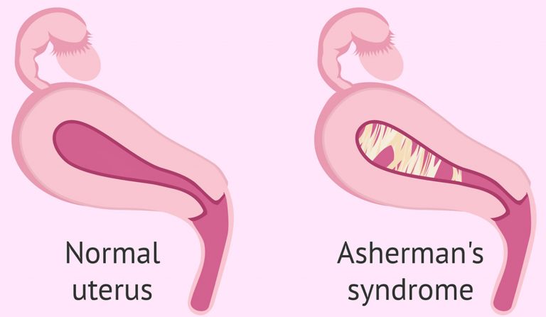 ASHERMAN’S SYNDROME | Chandigarh Ayurved & Panchakarma Centre