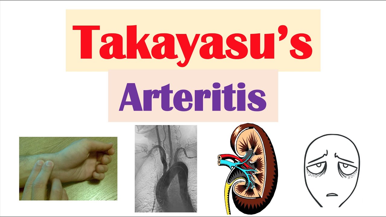 TAKAYASU’S ARTERITIS AND ITS AYURVEDIC TREATMENT | Chandigarh Ayurved ...